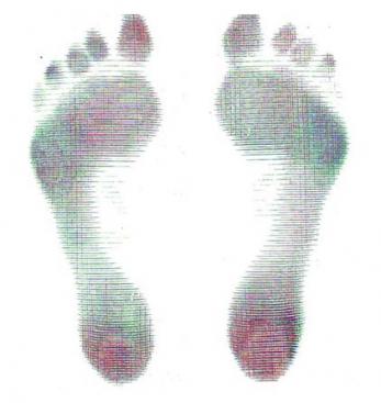 Pied creux – Mr Biss Podologue